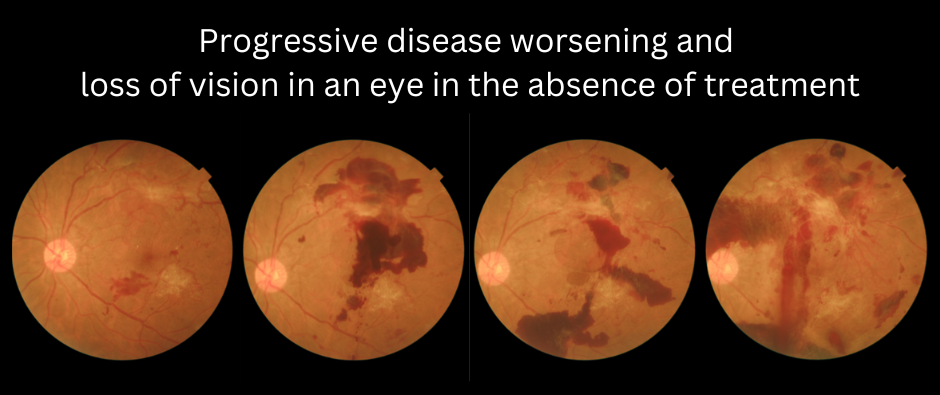 Diabetic Retinopathy – Vitreo Retina Society