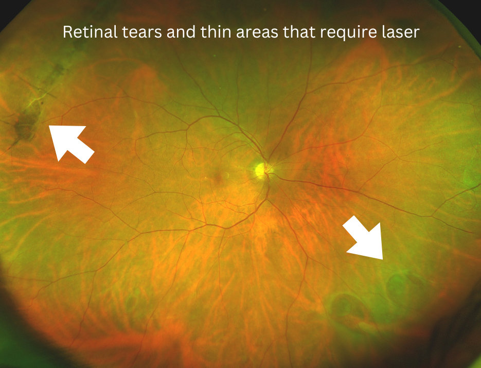 General FAQs on Retina – Vitreo Retina Society