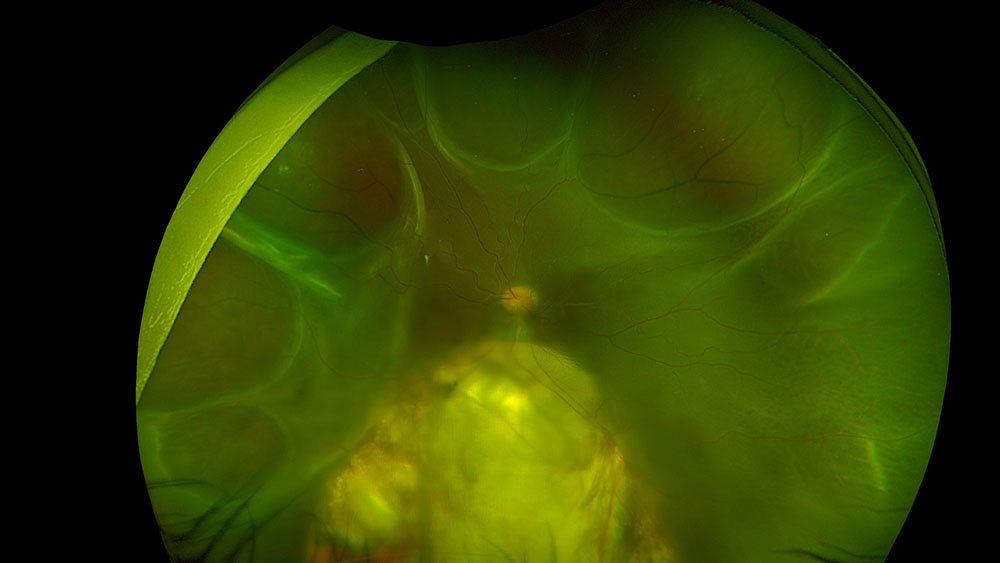 Winner of May 2023 – Vitreo Retina Society