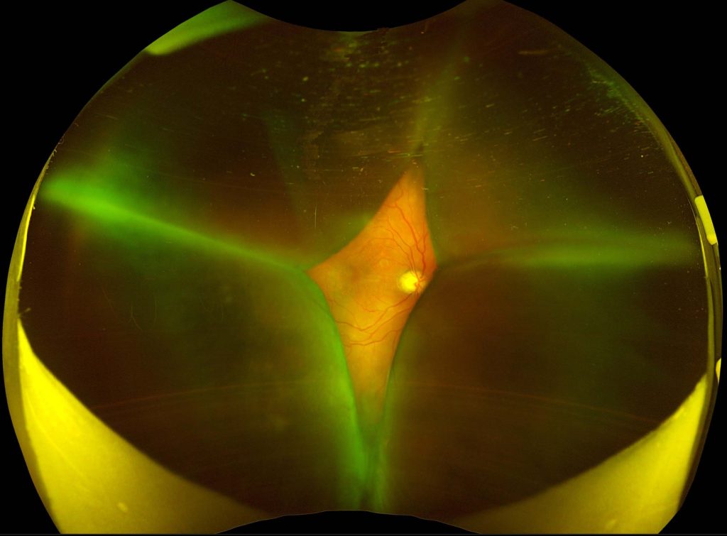 Winner of August 2023 – Vitreo Retina Society